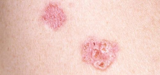 Start campagne huidkanker: Hoe ziet je huid er echt uit? – Stichting ...